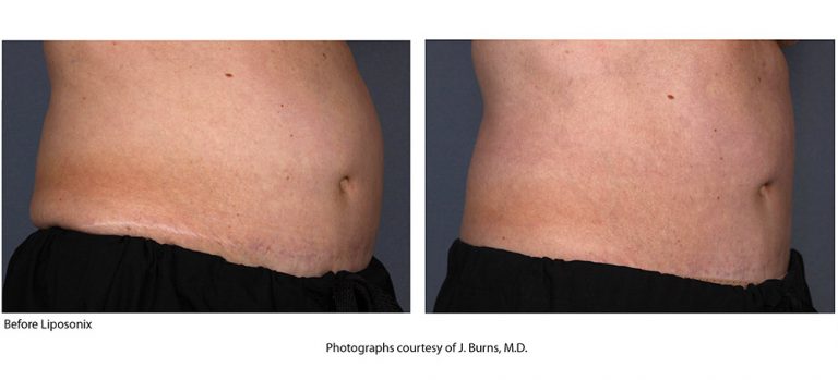 Non-surgical Fat Reduction with Liposonix Treatment
