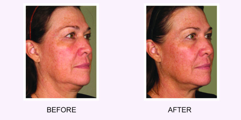 Non-invasive Neck, Chin, & Brow Lift with Ultherapy
