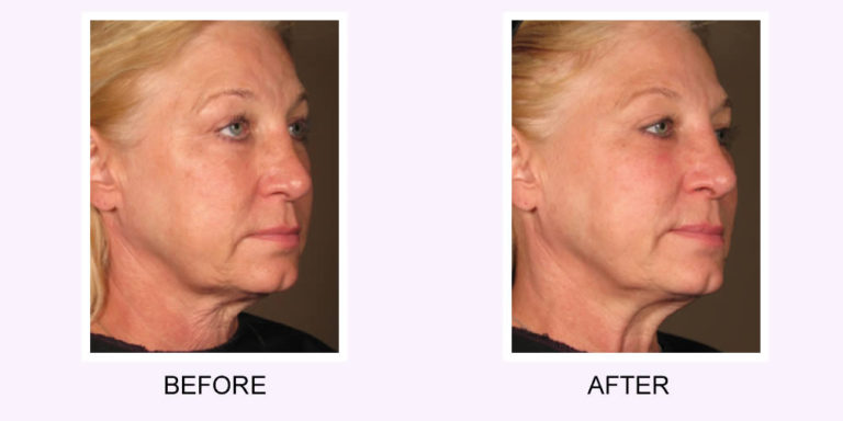 Non-invasive Neck, Chin, & Brow Lift with Ultherapy