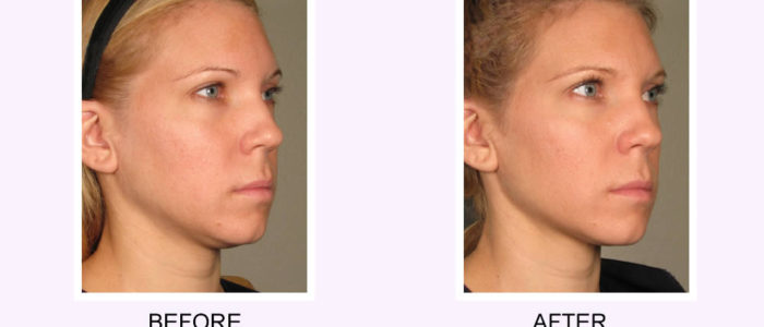 Non-invasive Neck, Chin, & Brow Lift with Ultherapy